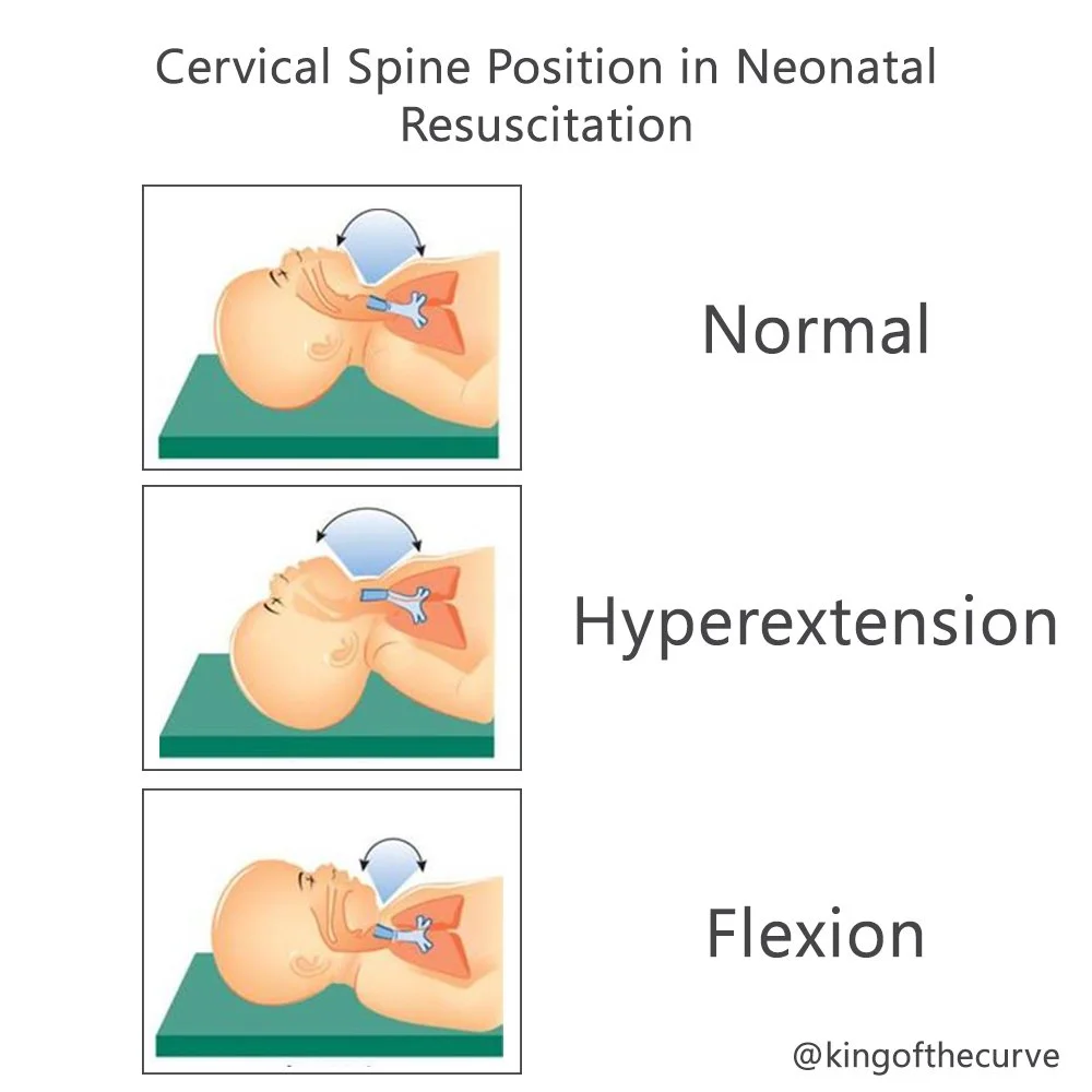 Cervical Spine Positioning in Neonatal Resuscitation: What Every Nurse ...