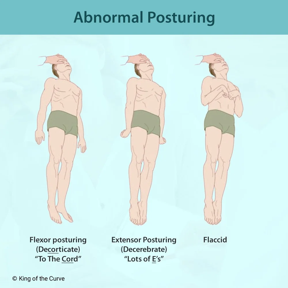 Abnormal Posturing NCLEX Guide: Decorticate vs. Decerebrate vs. Flaccid — King of the Curve