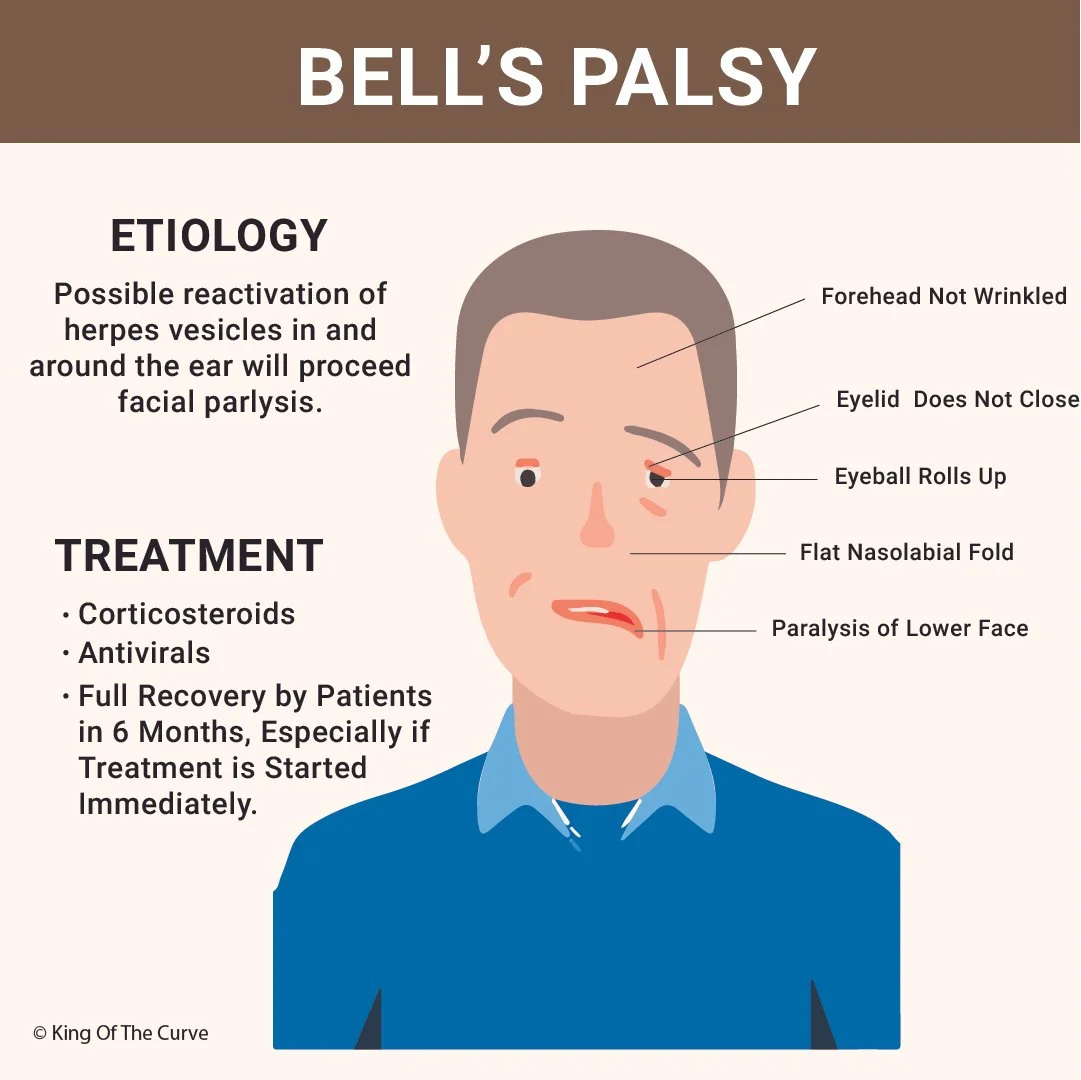 Bell s Palsy Symptoms Causes And Treatment Guidelines King Of The Bell s Palsy Symptoms Causes And Treatment Guidelines King Of The