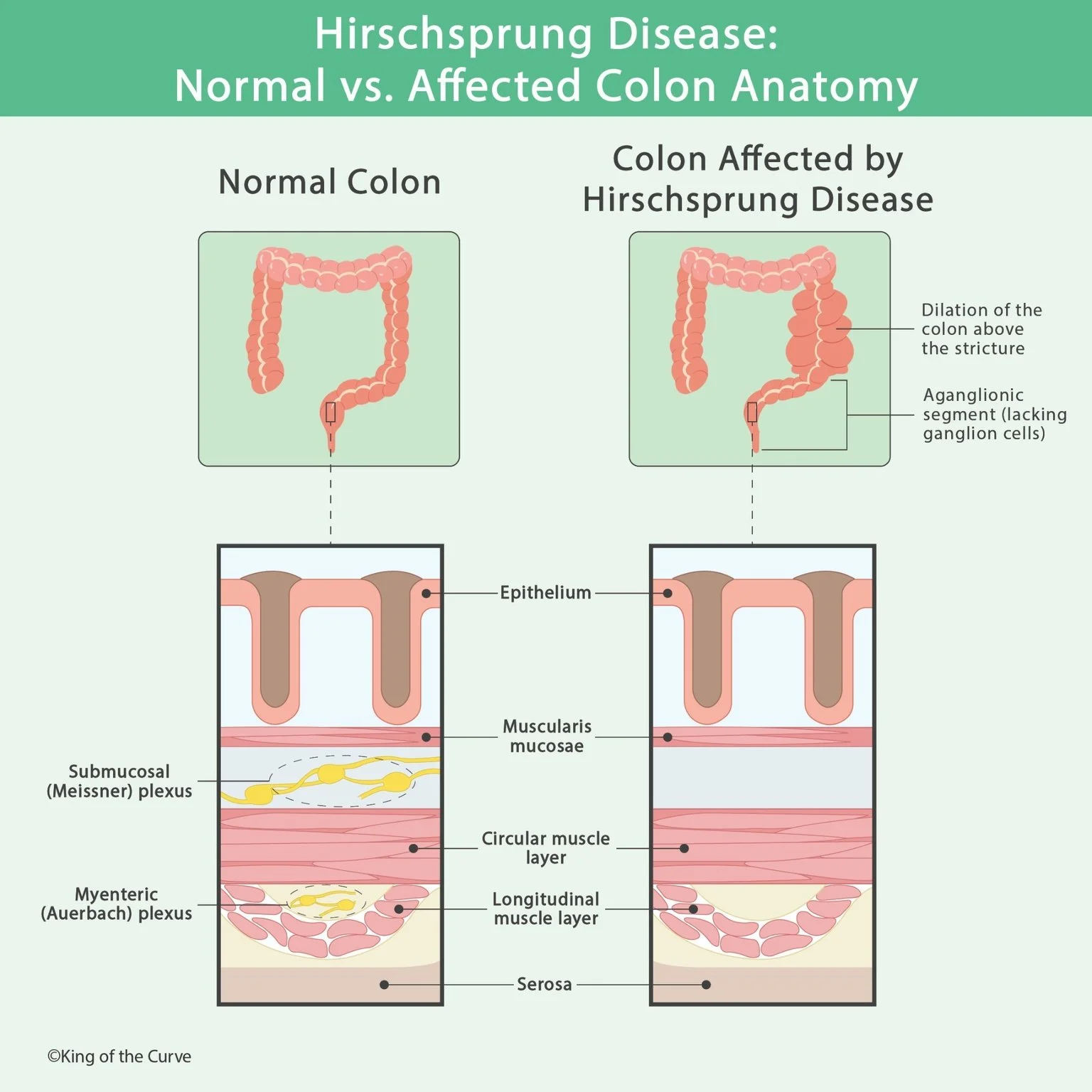 🧠 Hirschsprung Disease: Normal vs. Affected Colon Anatomy — King of the ...