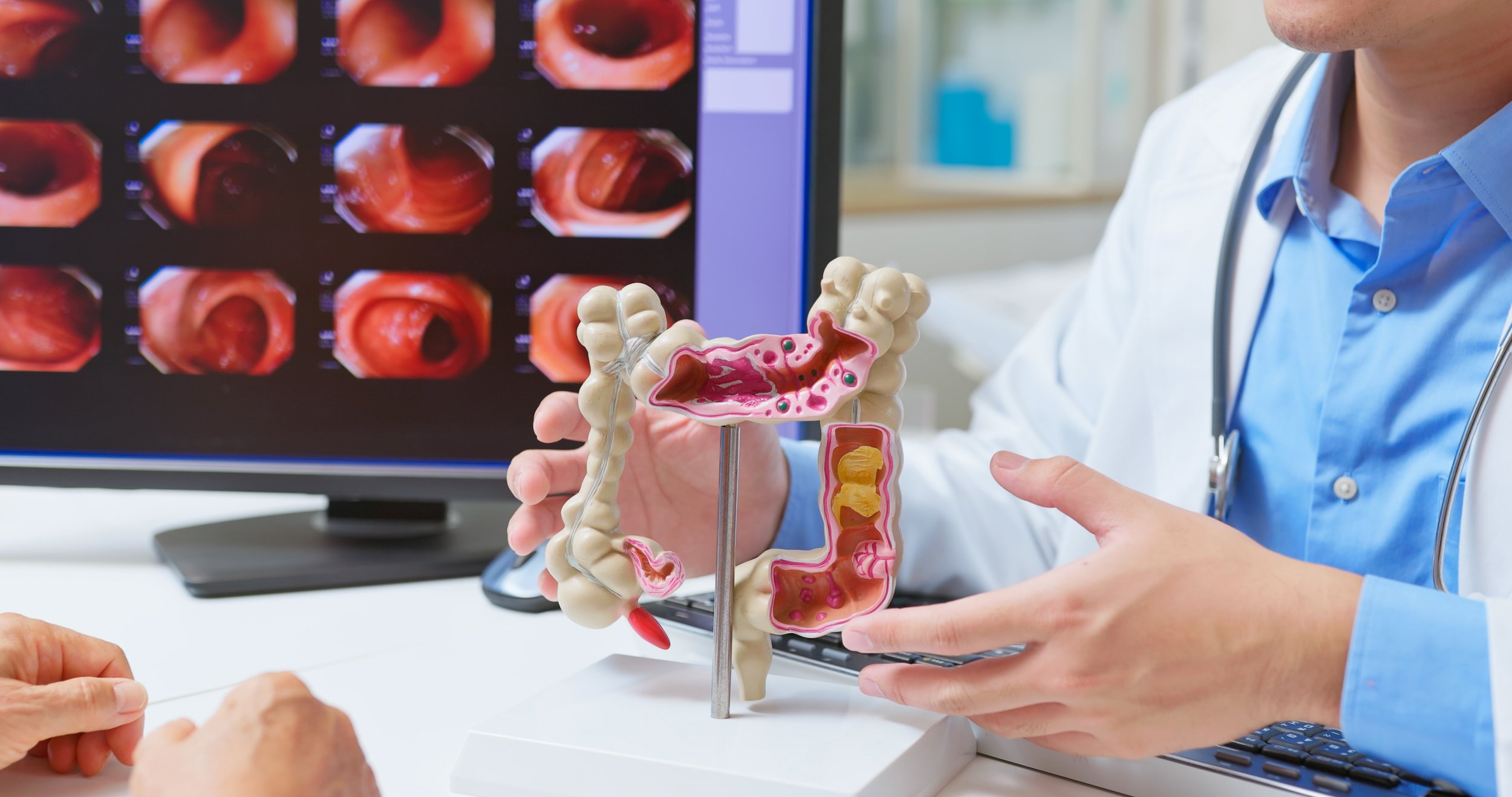 Understanding Colorectal Cancer: Current Evidence, Early Detection, and ...