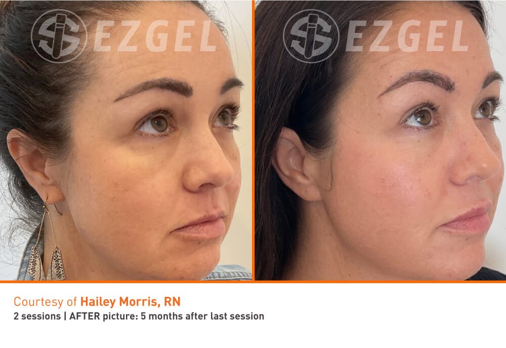 EZ PRF Treatment in Bedford, NH – Natural Skin Rejuvenation — Bombshell ...