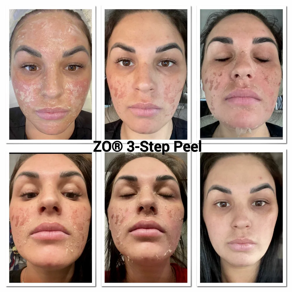 ZO 3 Step Peel Treatment & Mild Chemical Peel — Bombshell Aesthetics