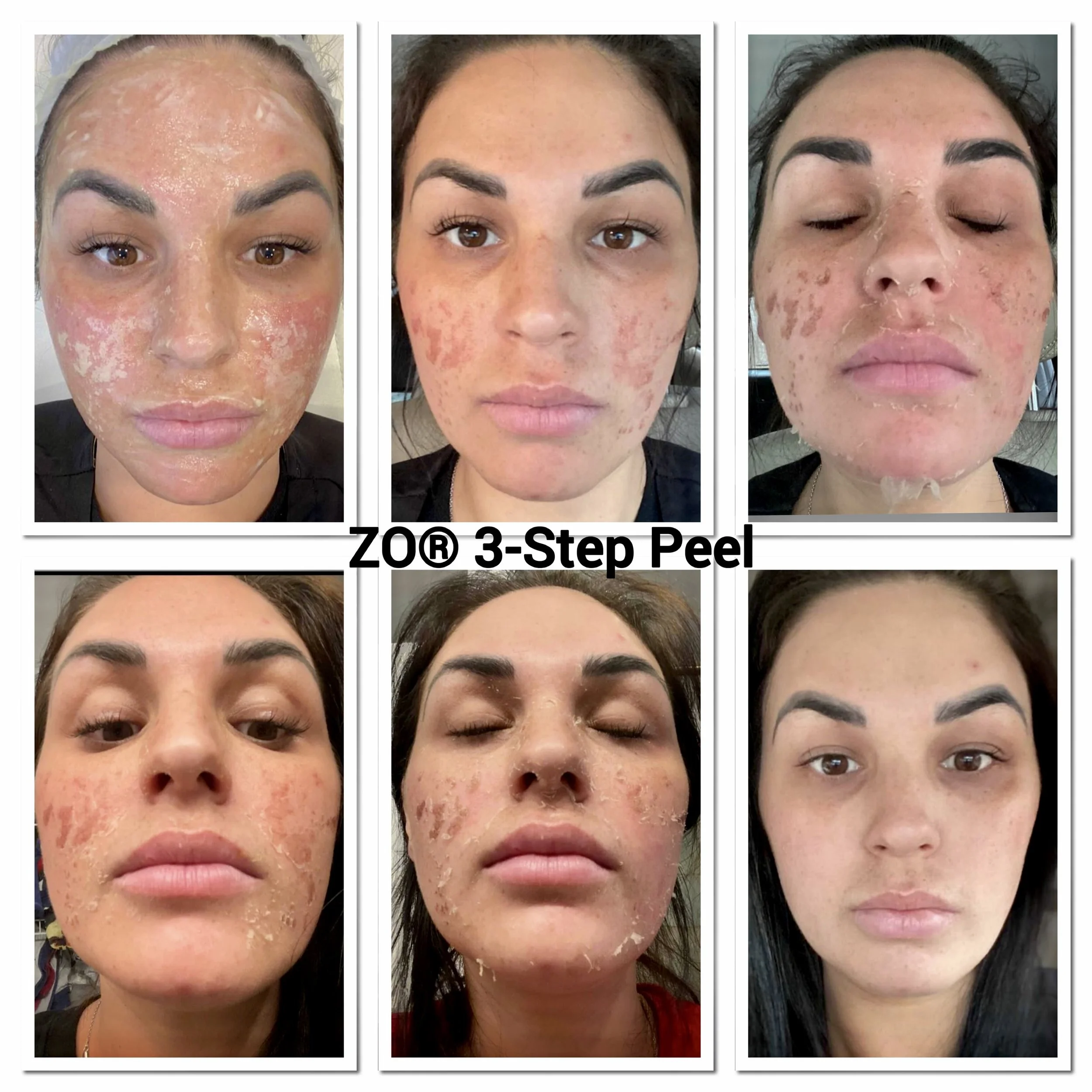 ZO Skin Chemical Peel Treatment — Bombshell Aesthetics