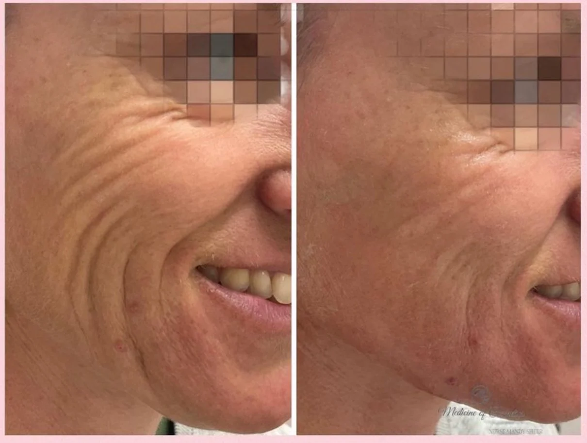 Stimulating Collagen Injections — SHEER AESTHETICS & INJECTABLES