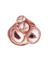 Medizinische Illustrationen der Herzoperation Aortoventriculoplasty ...