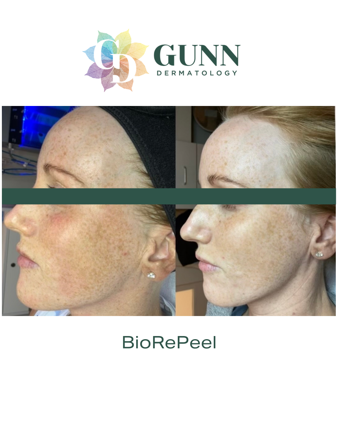 BioRePeel — Gunn Dermatology
