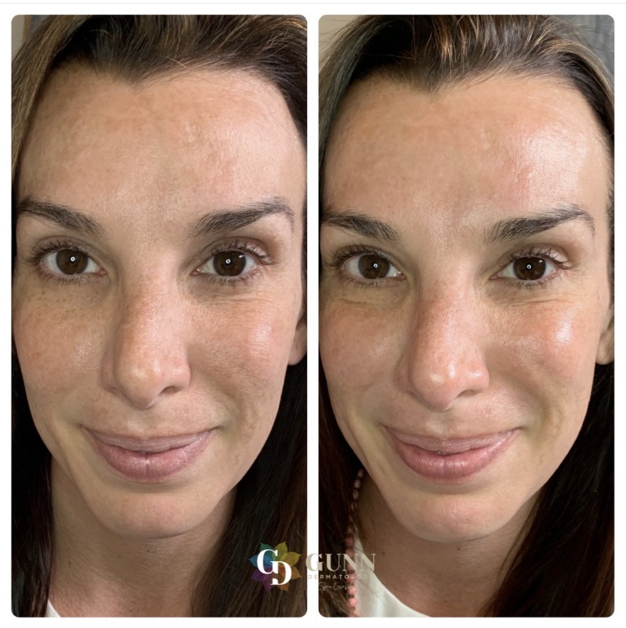 Diamond Glow — Gunn Dermatology