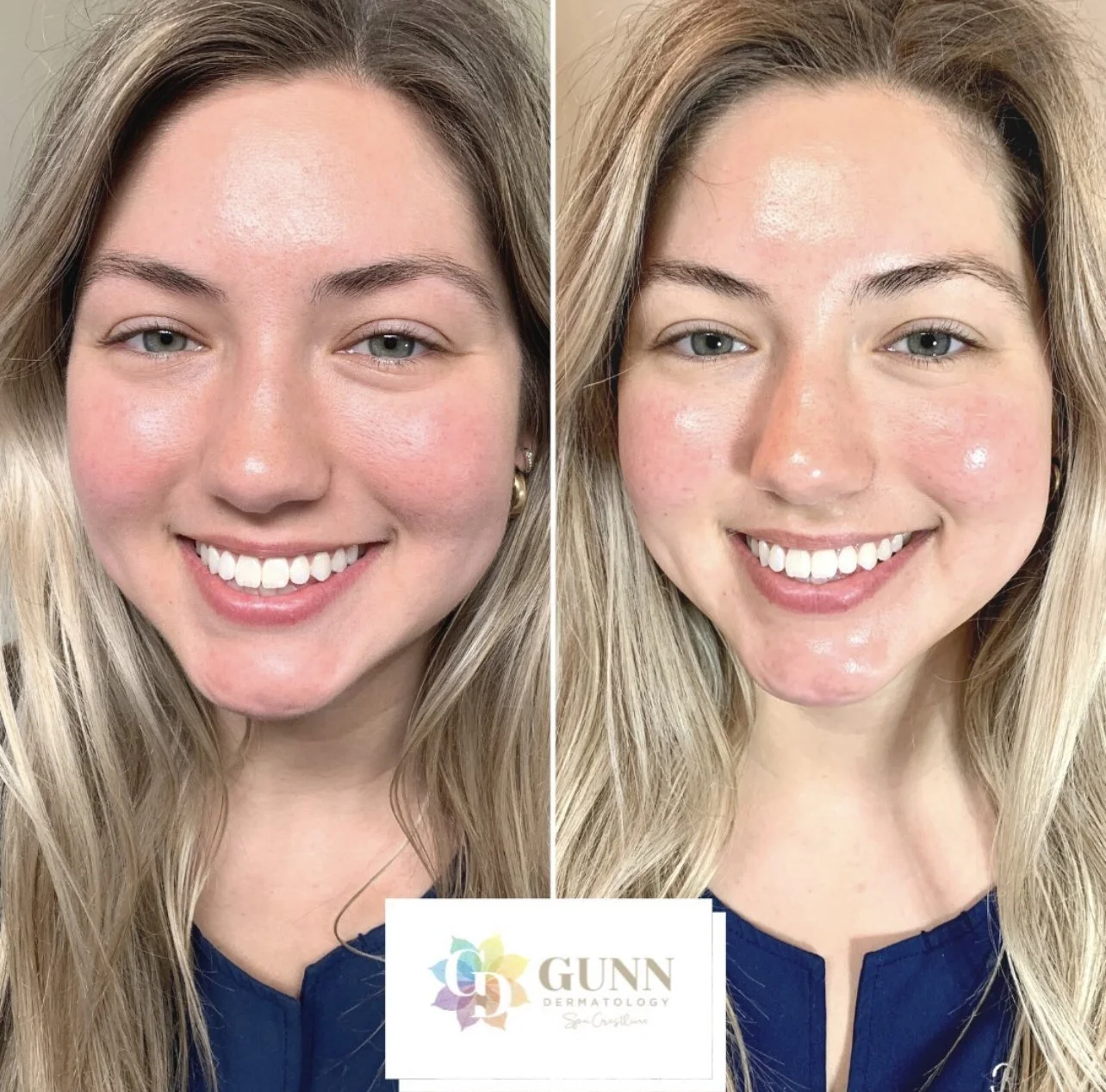 Hydrafacial — Gunn Dermatology