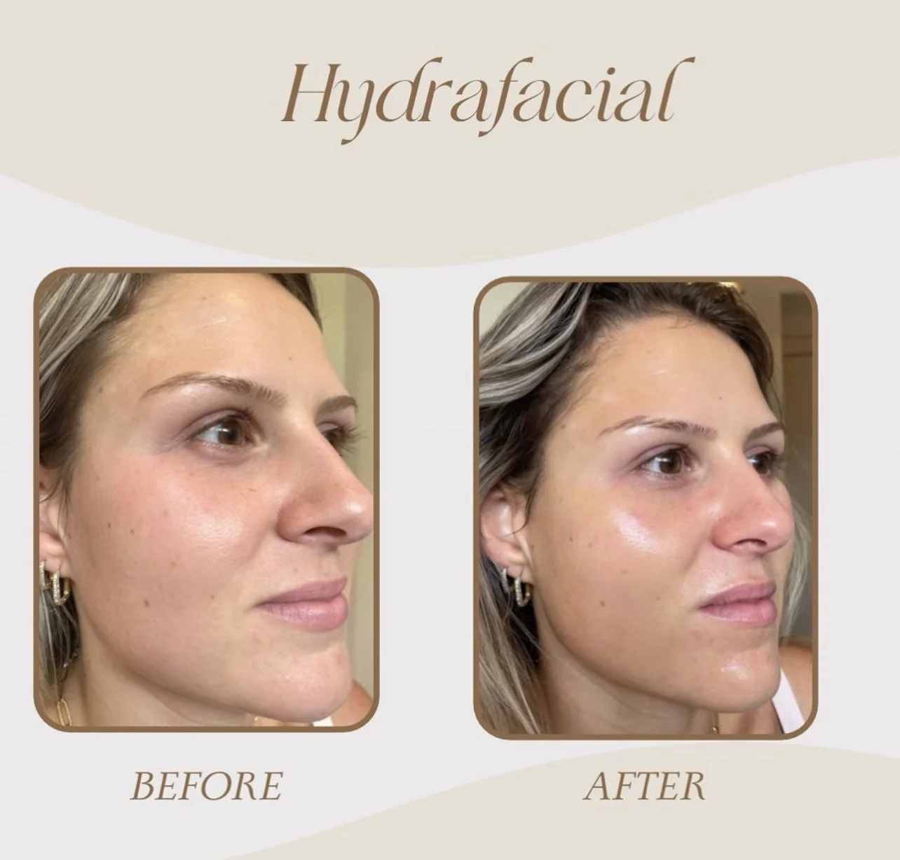 Hydrafacial — Gunn Dermatology