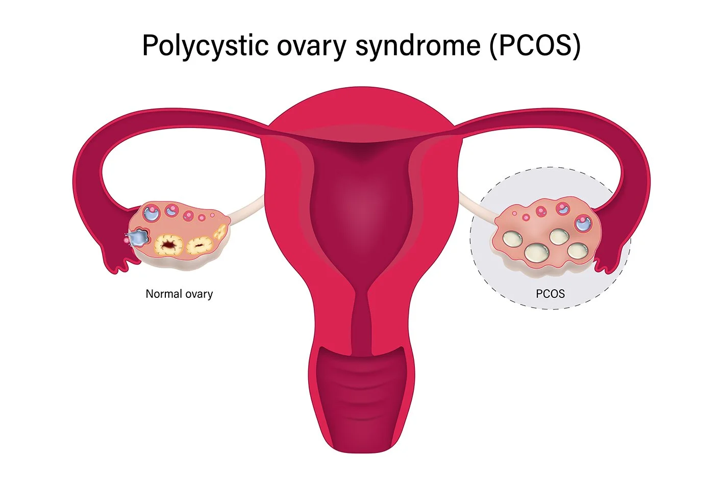 Polycystic Ovarian Syndrome Dr Jacqueline Brown Gynaecological Polycystic Ovarian Syndrome Dr Jacqueline Brown Gynaecological