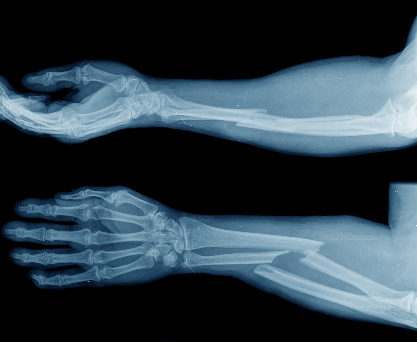 Orthopaedic Trauma Conditions — Dr Simon Lau | Orthopaedic Shoulder ...