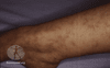 Livedo reticularis — Skin For All