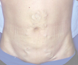 Caput medusae — Skin For All