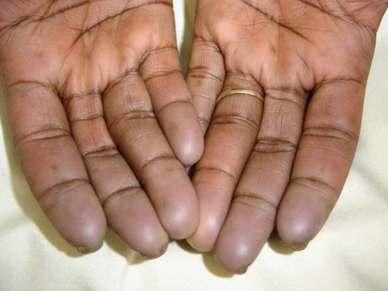 raynaud’s disease — Skin For All