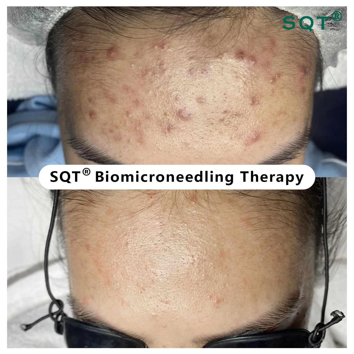 Gallery — SQT Bio-Microneedling