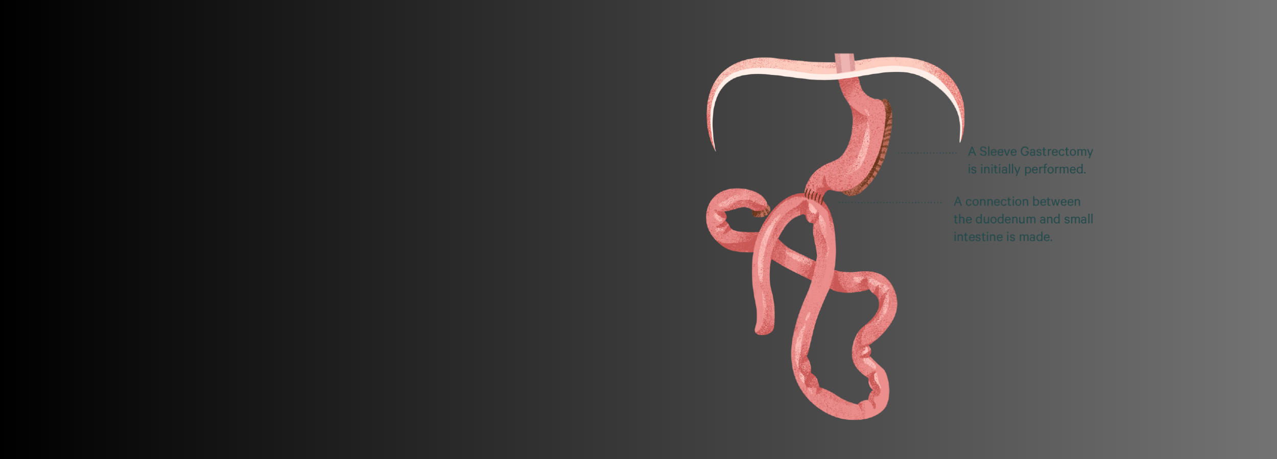 SADI-S — Premier Bariatric Institute