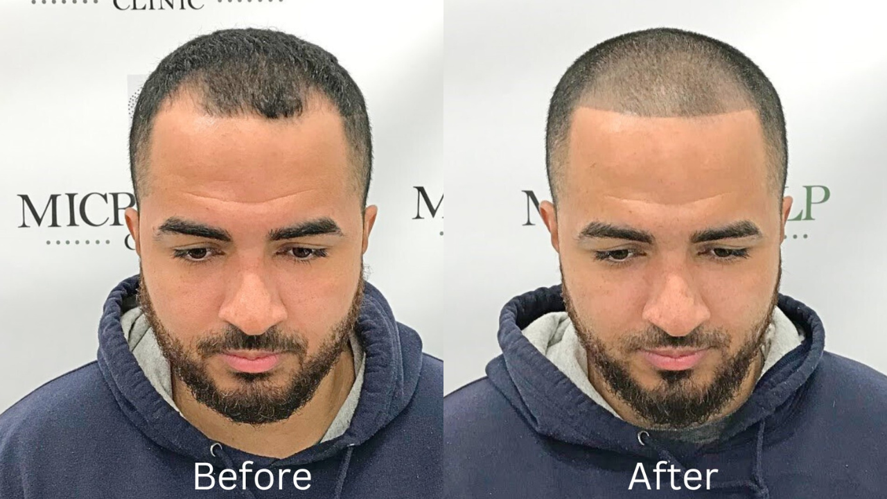 SMP Hair Services for Men | Hair Loss Treatment