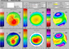 Keratoconus - Diagnosis and Treatment in Canberra — Jenny Wu Canberra ...