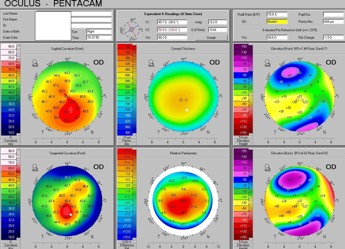 Keratoconus - Diagnosis and Treatment in Canberra — Jenny Wu Canberra ...
