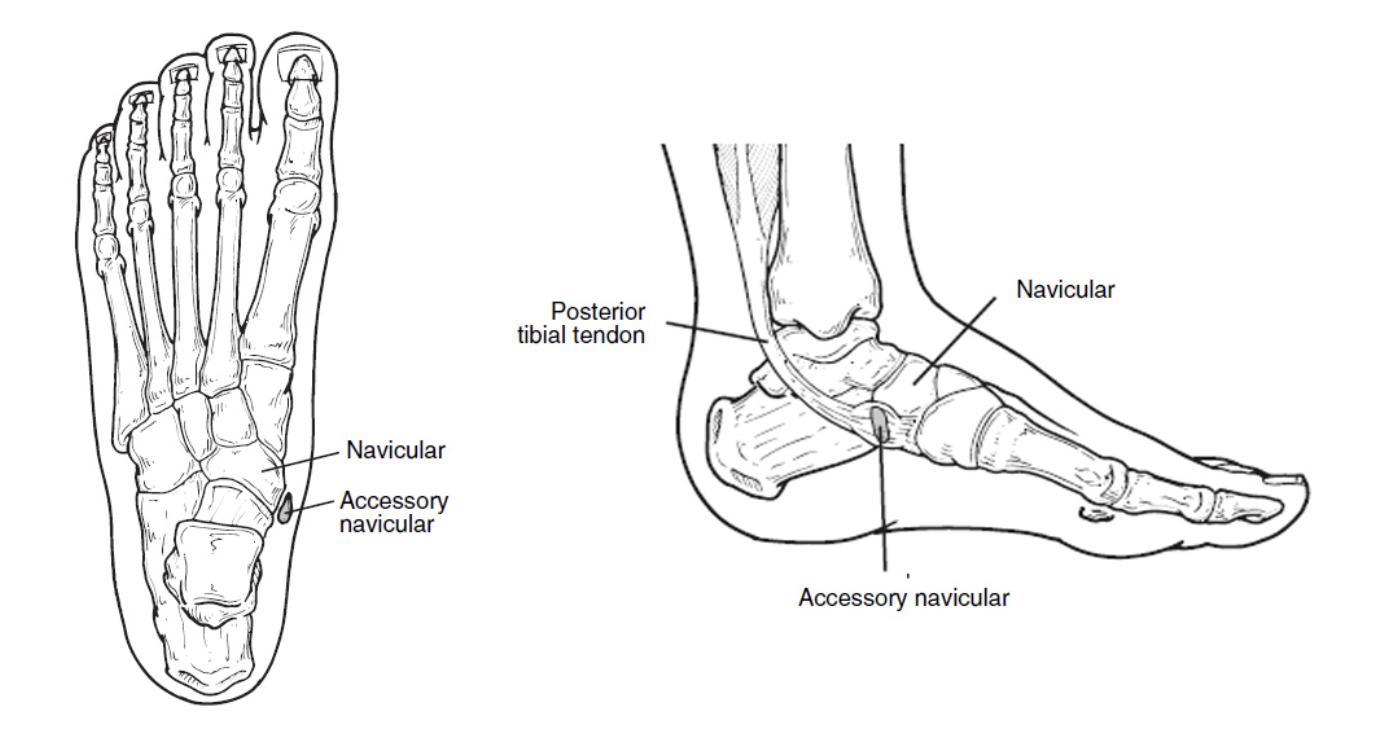Accessory Navicular Bone