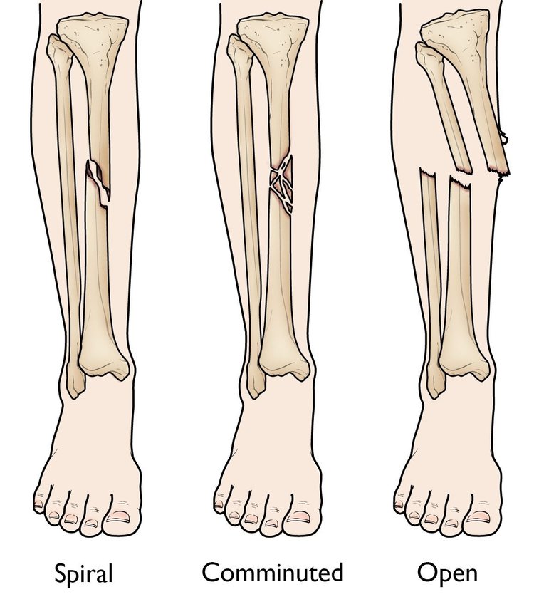 Kevin Ware Compound Tibia Fracture — Mending Playbook