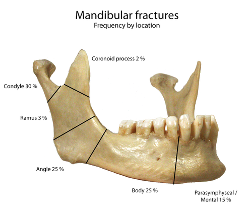 Kanye West 2002 Car Accident: Mandible Fractures — Mending Playbook