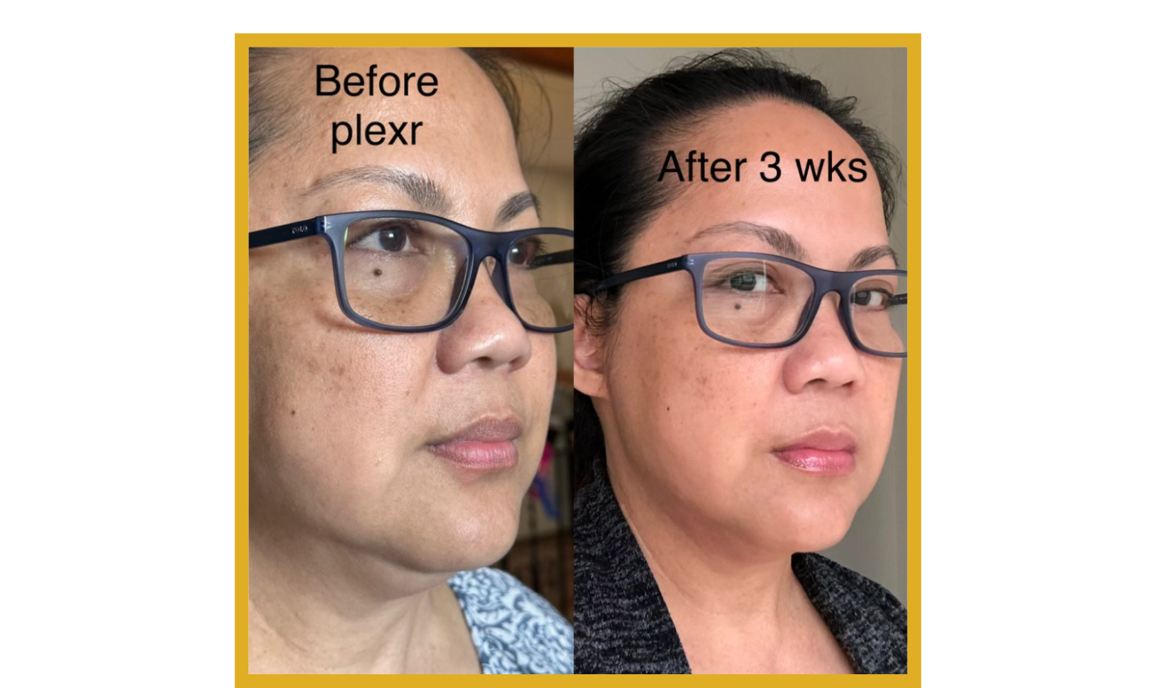 Plexr Plasma — SELF CARE 911 MEDSPA