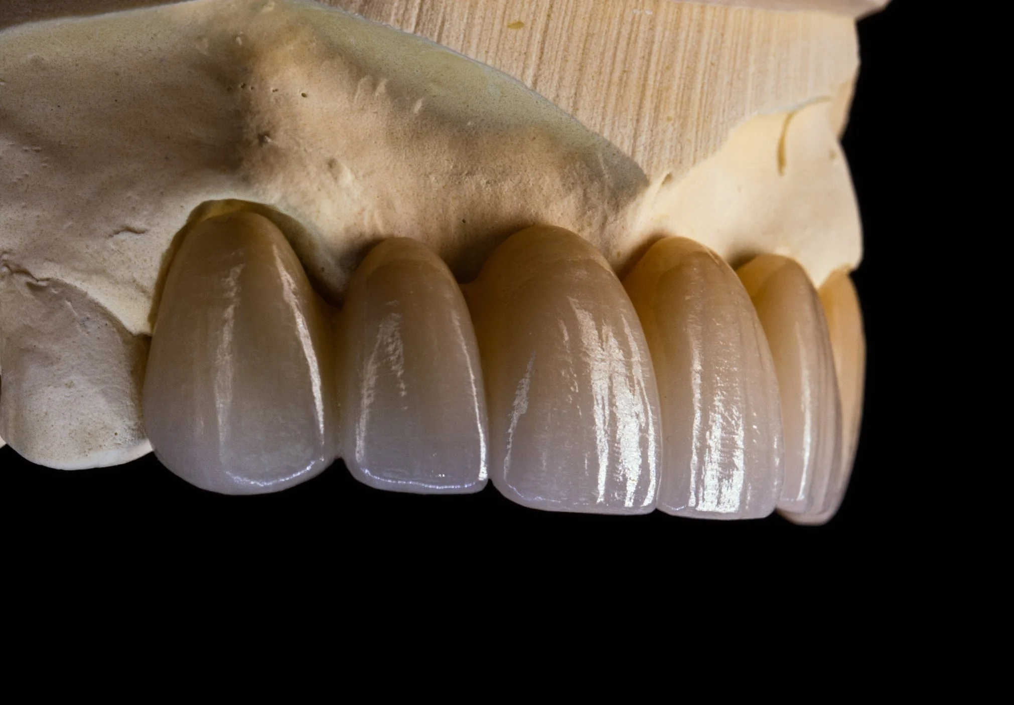 Diagnostic Wax-Ups — Aesthetic Oral Arts