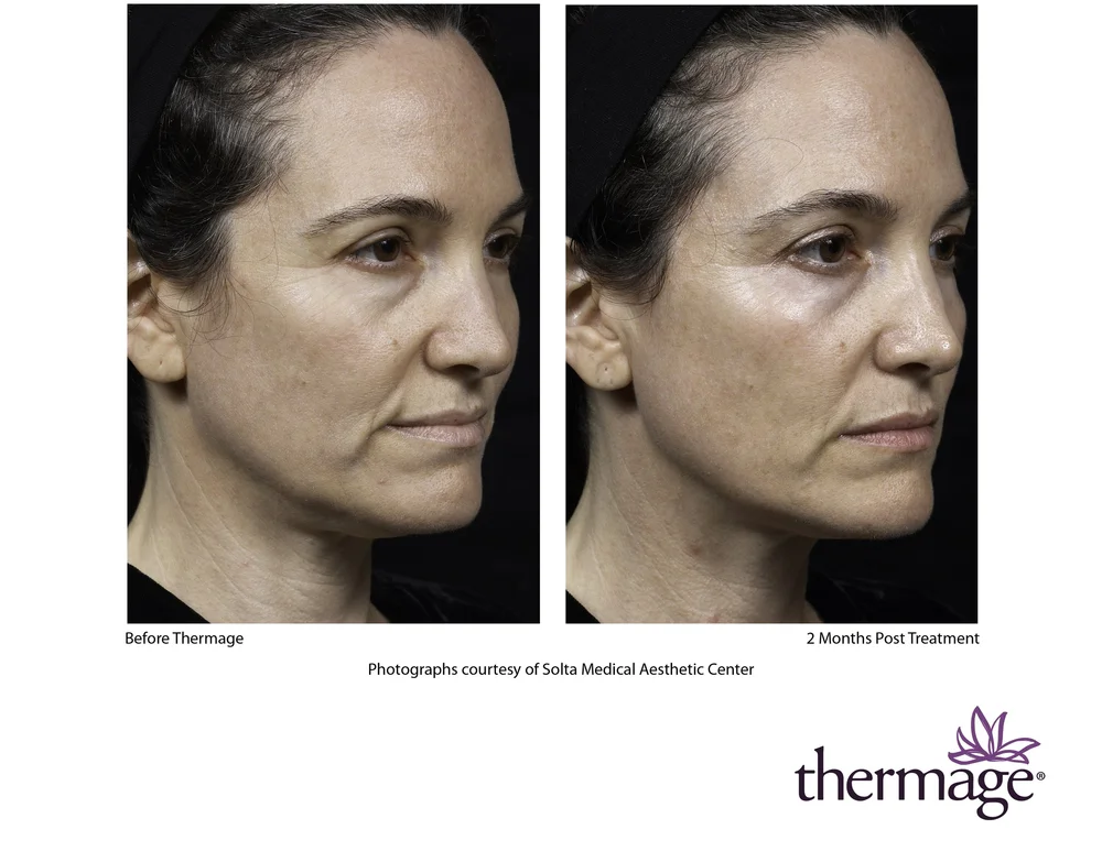 THERMAGE® FLX® | Achieve Youthful Skin — Skin Philosophy LIC: Expert ...