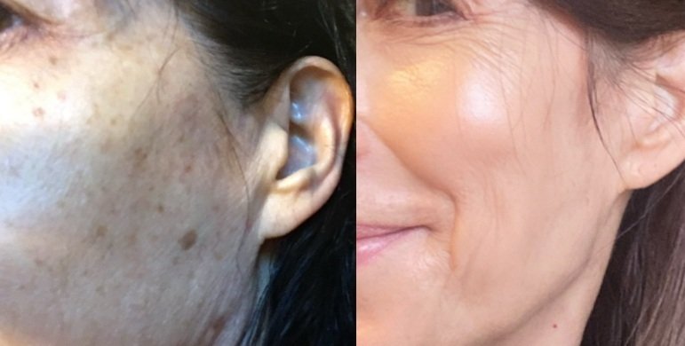 My Skin Transformation After 50: What Really Worked to Fade My Brown ...