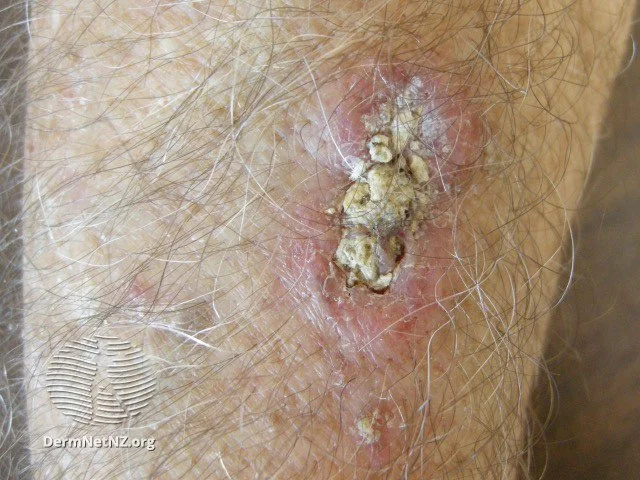Squamous Cell Carcinoma Causes, Symptoms and Treatment Columbus, Ohio ...