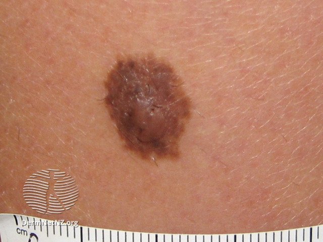 Moles (Nevi) Causes, Symptoms and Evaluation in Columbus, Ohio | Rixis ...