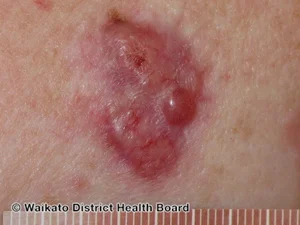 Basal Cell Carcinoma Causes, Symptoms, and Treatment in Columbus, Ohio ...