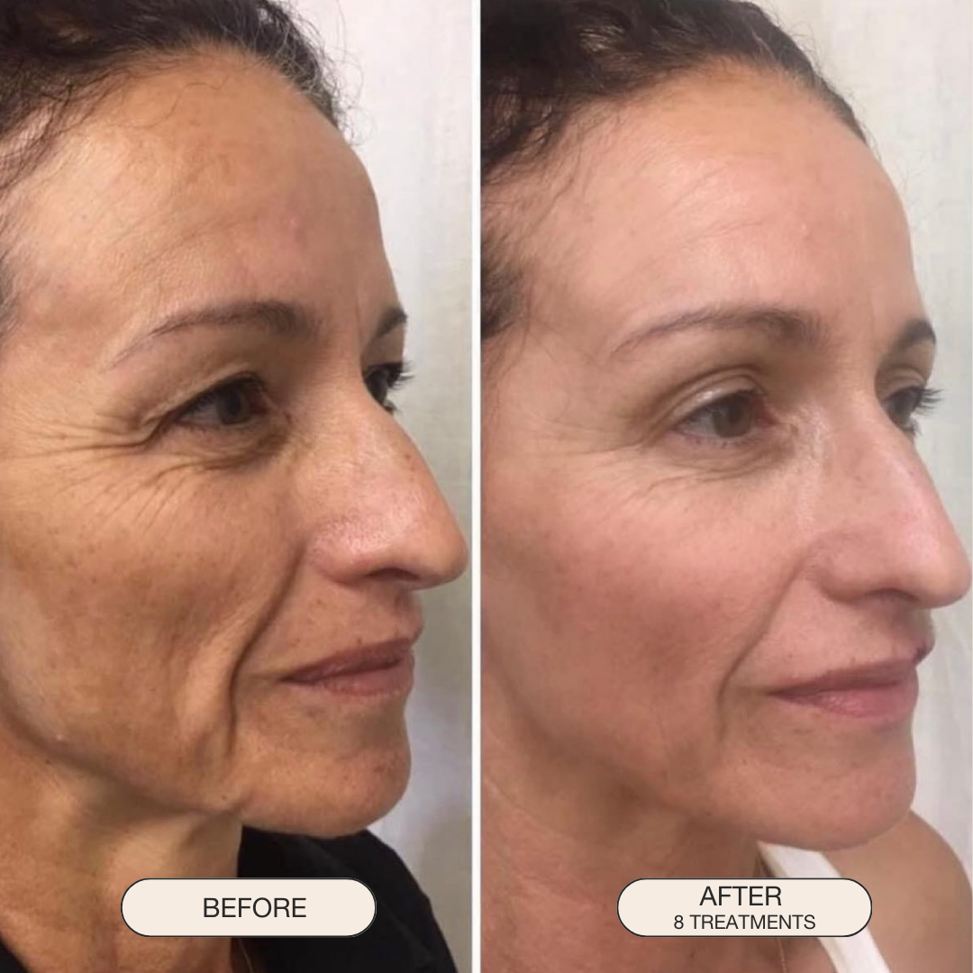 Revolutionary Endosphères Therapy at Skin Rehab Beverly Hills ...