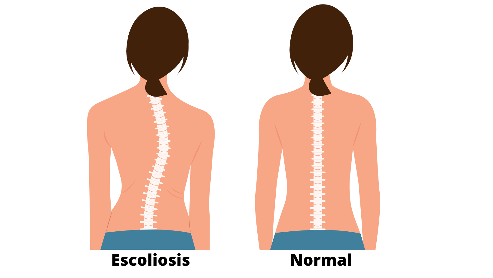 Escoliosis — Dr. Jorge Martínez