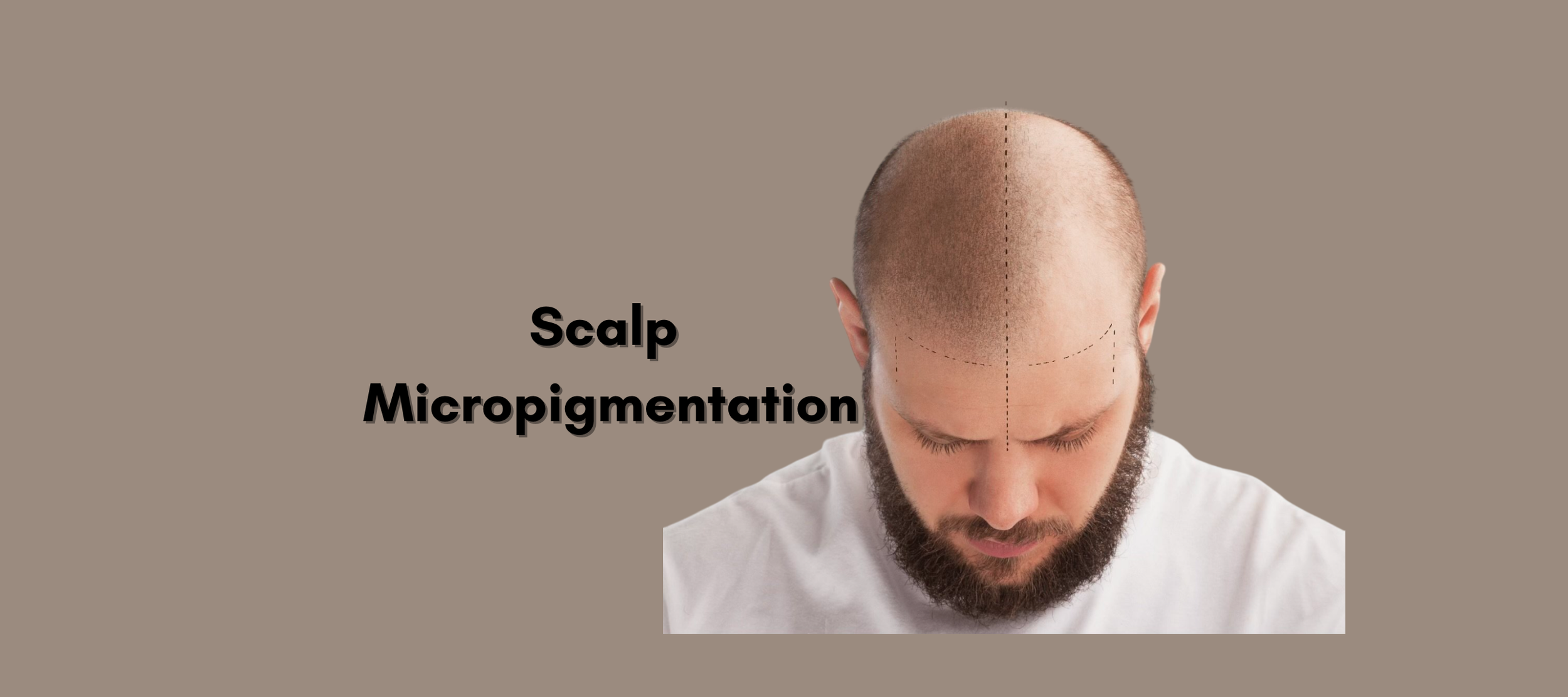 Scalp micropigmentation S.M.P — Revive & Rebalance