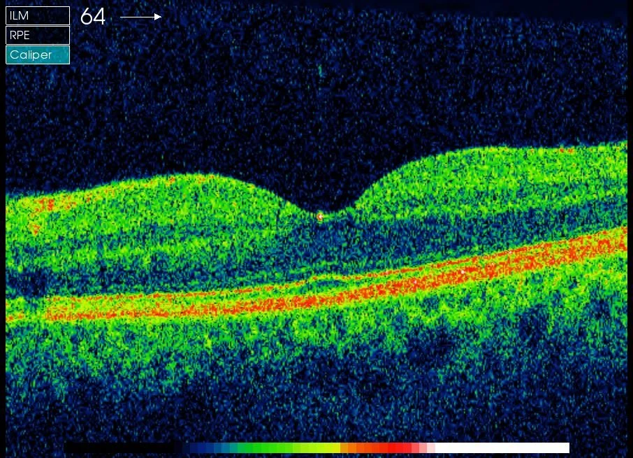 Glaucoma Care — Vision North Boston | Comprehensive Eye Care