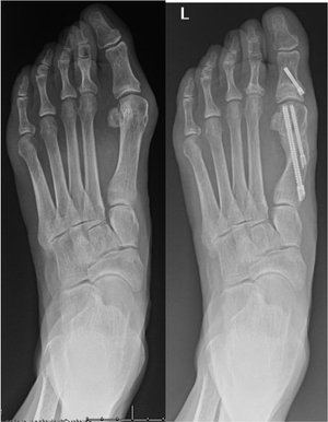 Minimally Invasive Chevron Osteotomy — Dr. Sagar Desai