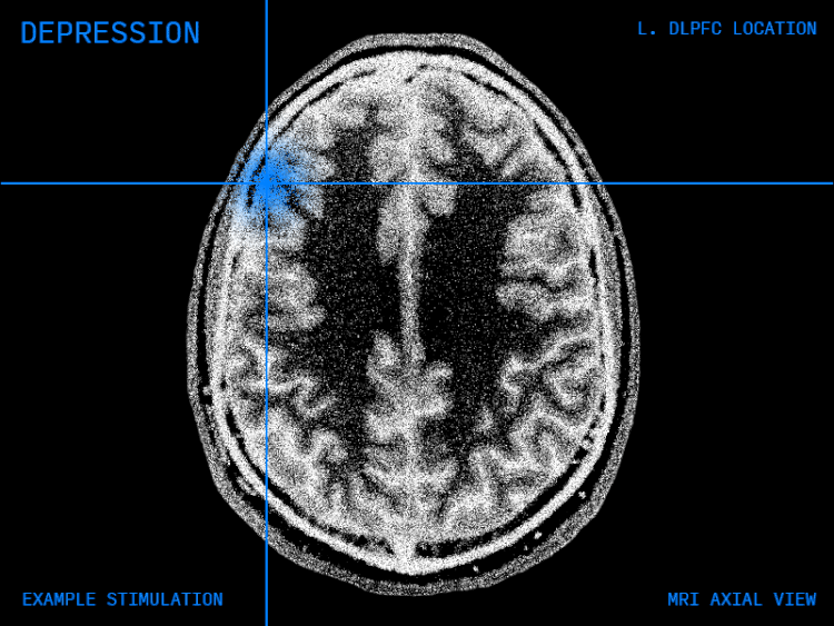 TMS Therapy | A Better, Faster Way to Treat Depression — Acacia Clinics