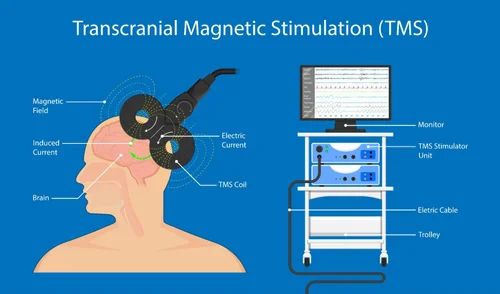 The History of TMS: What it is, How it Works, and Its Effectiveness for ...