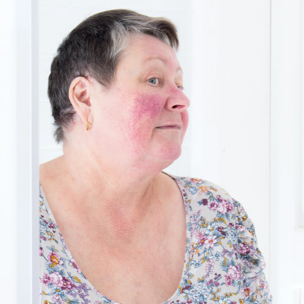 Rosacea Treatment | Clear Skin Awaits — DermaEnvy Skincare | Medical ...