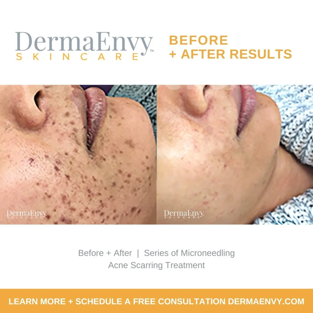 Facial Near Me — DermaEnvy Skincare | Medical Aesthetics , Laser Hair ...