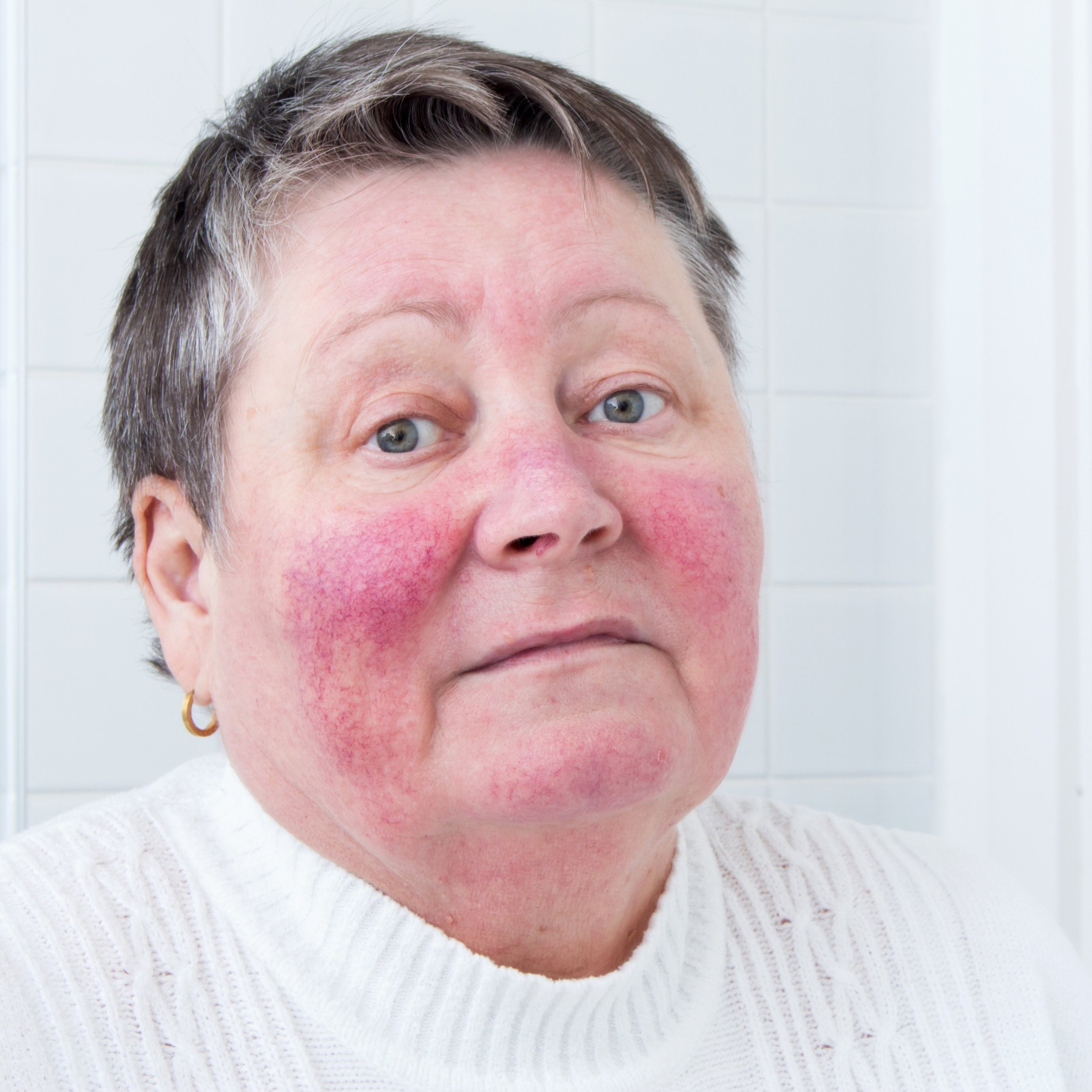 Rosacea Treatment | IPL & Laser Therapy | DermaEnvy Skincare ...