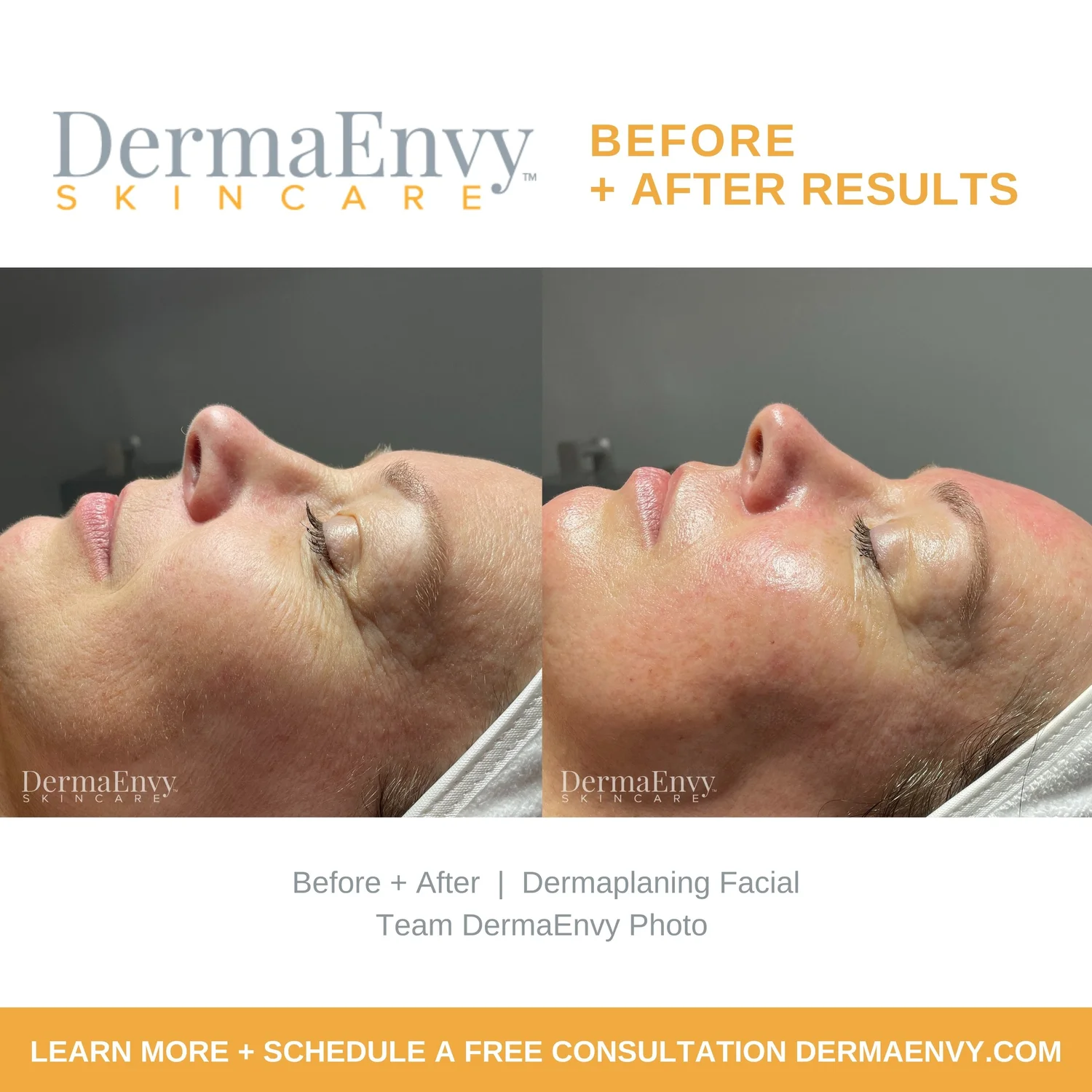 Dermaplaning Facial | Refresh Your Skin Today — DermaEnvy Skincare ...
