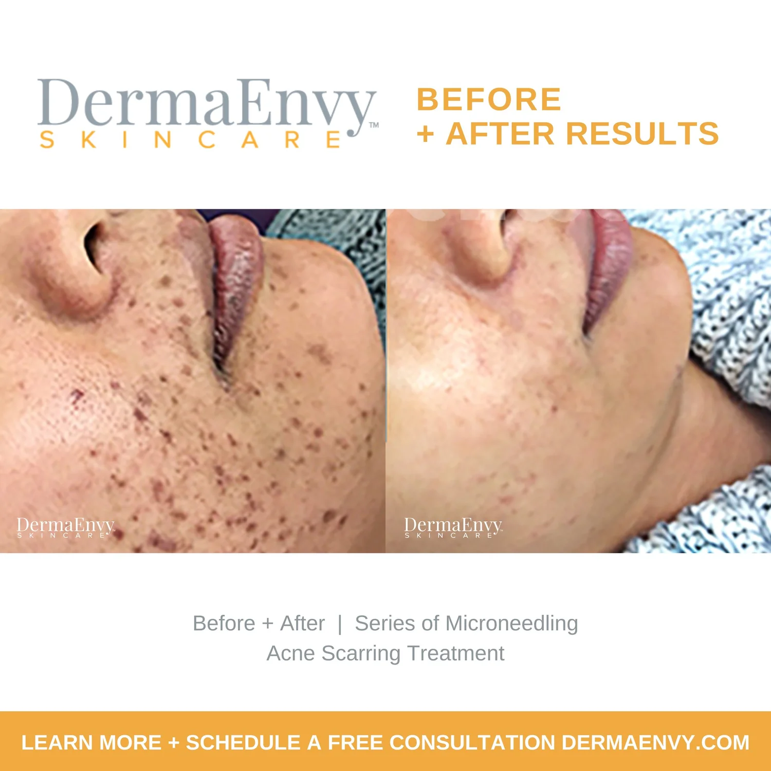VAMP Facial Salmon DNA Microneedling Treatment | Discover Youthful Skin ...