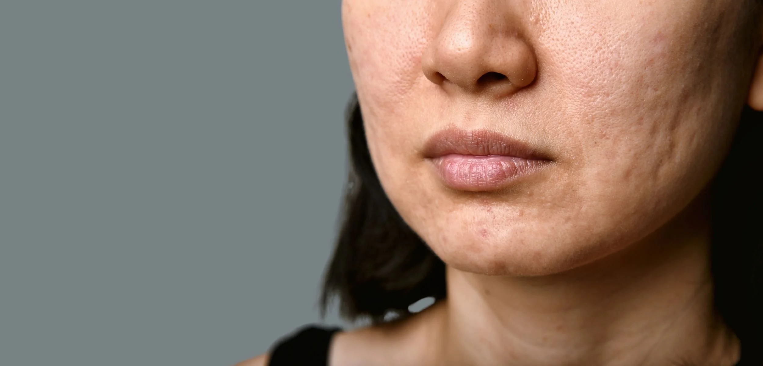 Acne Scarring Treatment — DermaEnvy Skincare | Medical Aesthetics ...