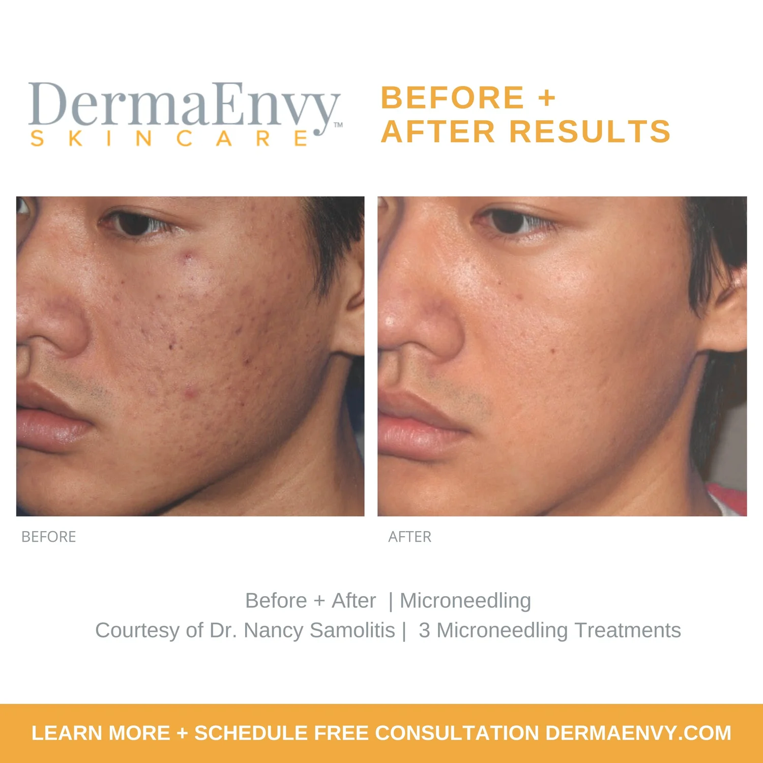 VAMP Facial Salmon DNA Microneedling Treatment | Discover Youthful Skin ...