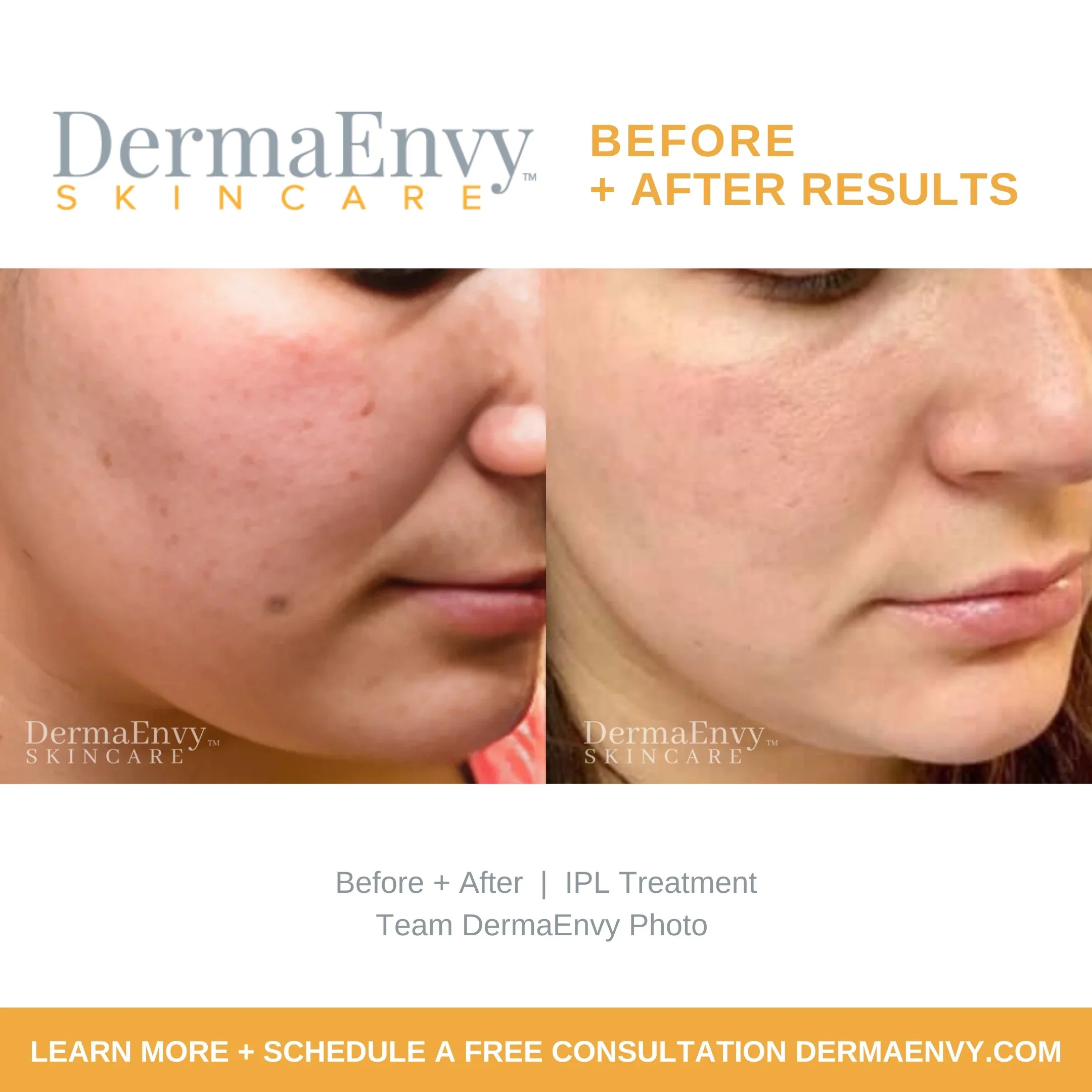 Facial Near Me — DermaEnvy Skincare | Medical Aesthetics , Laser Hair ...