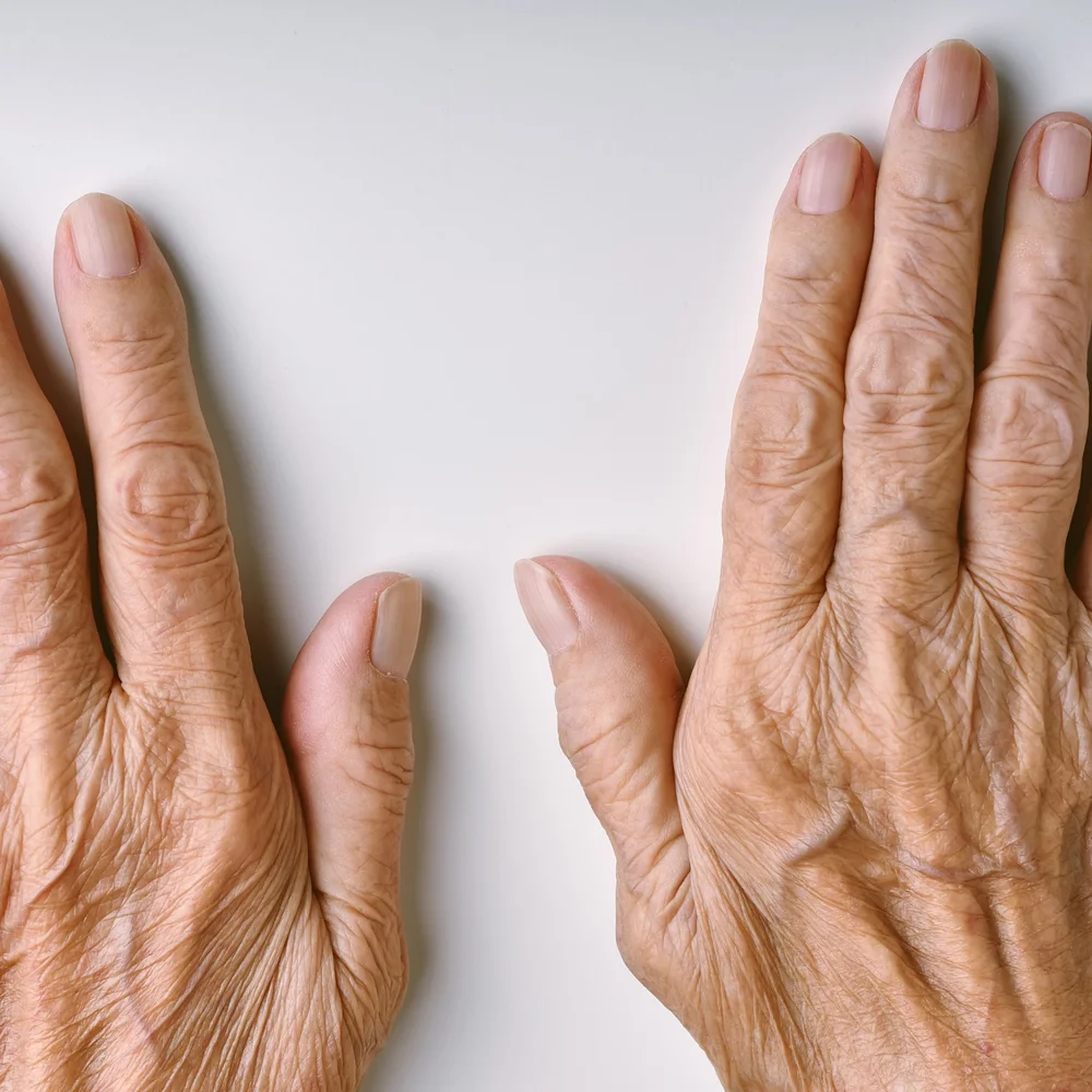 Aging Hands — DermaEnvy Skincare | Medical Aesthetics , Laser Hair ...